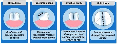 tooth fracture classification