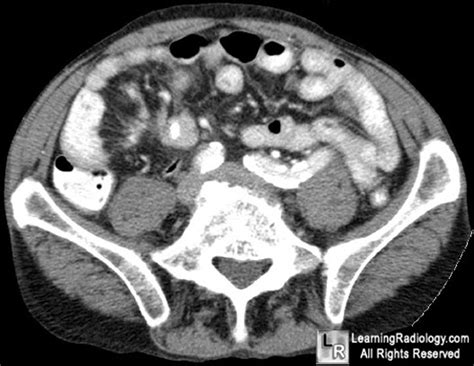 Carcinoid Syndrome Radiology