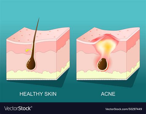 Acne Cross Section Of A Human Skin With Pimple Vector Image