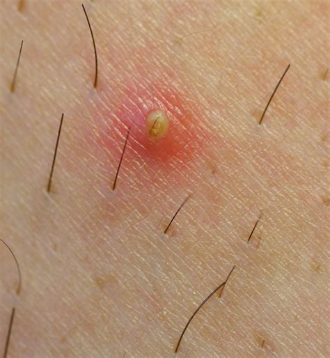 La Foliculitis Es Más Común De Lo Que Imaginas Aba