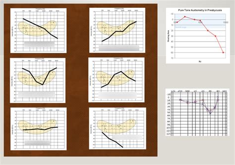 4714 Different Types Of Audiograms Diagram Quizlet