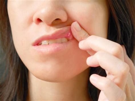 Are Canker Sores Contagious Know Differentiation With Cold Sores