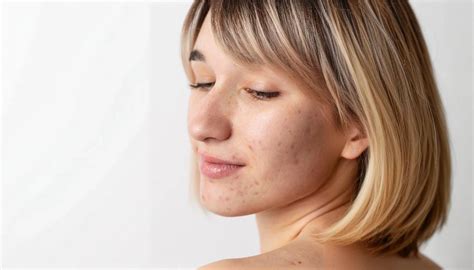 What Is Post Inflammatory Hyperpigmentation Skin To Heart
