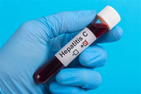 Hep C Reinfection Observed In Hiv Men Who Have Sex With Men