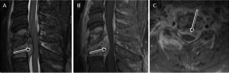 Imaging Based Approach To Extradural Infections Of The Spine Pmc