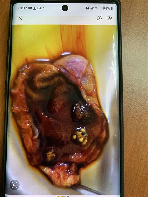 My Big Polyps Lol They Are Benign Thank God Rgallbladders