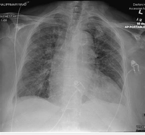 Initial Chest Xray Showed Increased Interstitial Markings Reviewing