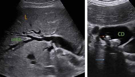 Imaging Of Biliary Tree Intechopen