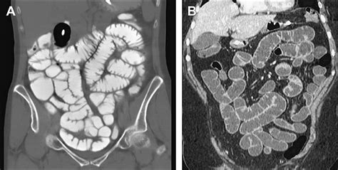 Fluoroscopic And Ct Enteroclysis Radiologic Clinics