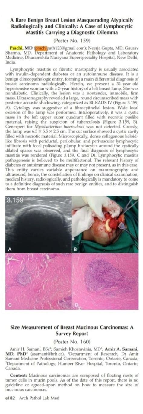 Neerja Gupta On Linkedin Lymphocytic Mastitis Is A Rare Condition One