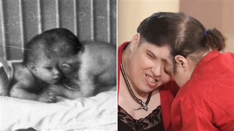 Aged 62 Worlds Oldest Conjoined Twins Have Defied All Expectations Guinness World Records