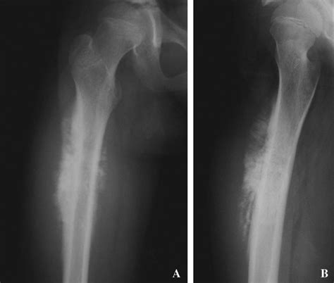 Bone Cancer X Ray