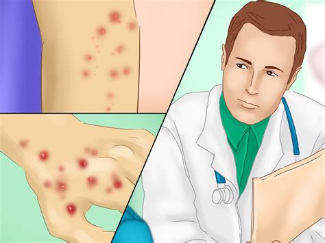 How To Prevent Scabies Steps With Pictures WikiHow