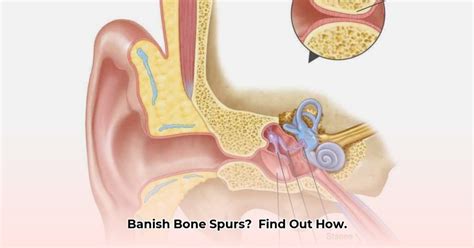 Exostectomy Surgery Effective Bone Spur Removal Chaztin