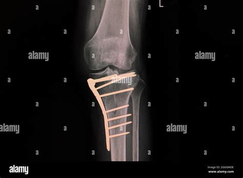 Anatomía De La Tibia Proximal