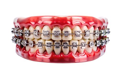 Closeup View Of A Dental Model Showcasing Meticulously Detailed