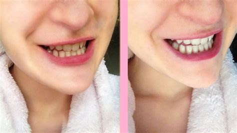 Does Crest Whitening Emulsion Work Mysocialkesil