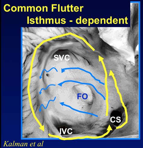 Atrial Flutter Facts You May Want To Know Dr John M