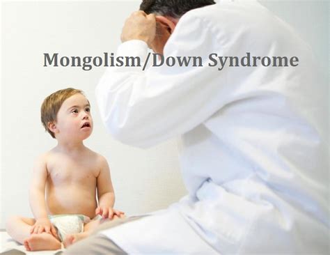 Mongolism Down Syndrome Treatment Neurotherapy India
