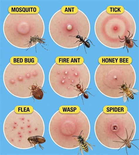 What Do Different Bug Bites Look Like Artofit