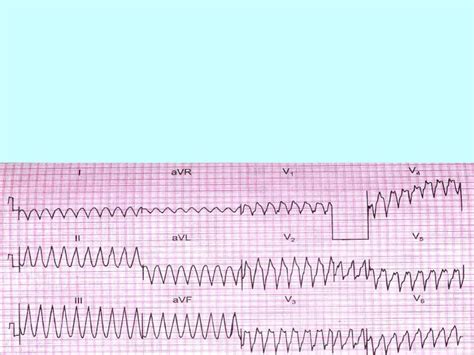 ПВБ ЛД экг№2 Стр 4