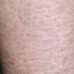 Ichthyosis Vulgaris Definition Of Ichthyosis Vulgaris