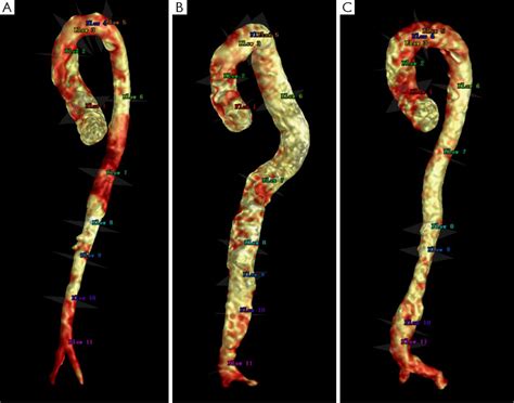 Figure 1 From Assessment Of Aortic Hemodynamics In Patients With Thoracoabdominal Aortic