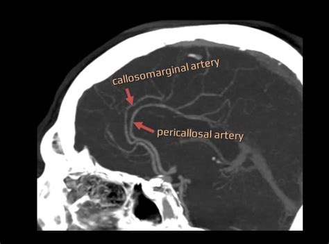 Lesions Of The Corpus Callosum Stroke Manual