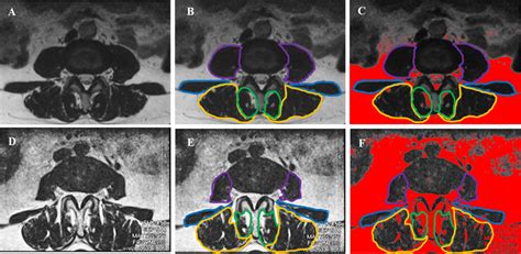 Roi Based Measurement Of Rmcsa And Fi In Lss Patients And Dsi Patients