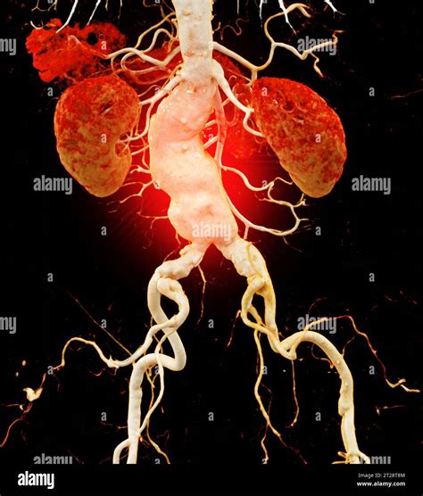 Cta Abdominal Aorta Showing Abdomenal Aortic Dissection 3d Rendering