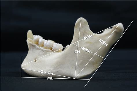 Figure 1 From Gender Difference In Thai Mandibles Using Metric Analysis Semantic Scholar
