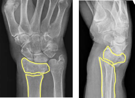 I Have A Broken Wrist A Primer On Distal Radius Fracture Surgery Dr Nick Golinvaux