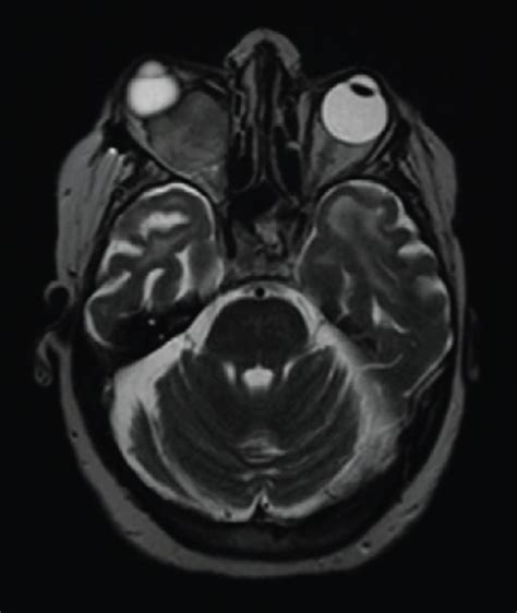 Case 4 A Ct Imaging With A Great Lesion Hyperdense Morphology