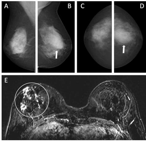 Can Mammography Based Ai Enhance Breast Mri Use In Patients With Intermediate Risk For Breast