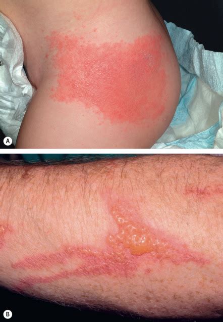 Allergic Contact Dermatitis Plastic Surgery Key