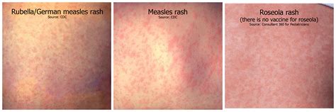 Rubella Rash Images