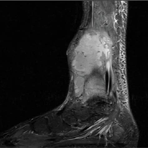 Mri Left Tibia Test Near You In Delhi Book Test At Low Price