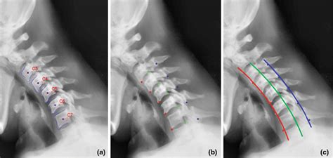 Vertebra Alignment Measurement Steps A Vertebra Segmentation B Key