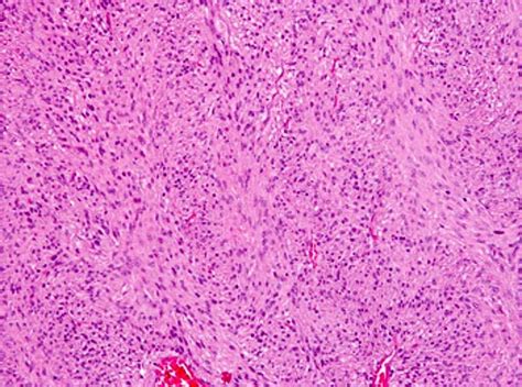 Histopathological Aspects Of Case 2 Tumors A Duodenal Gist Spindle