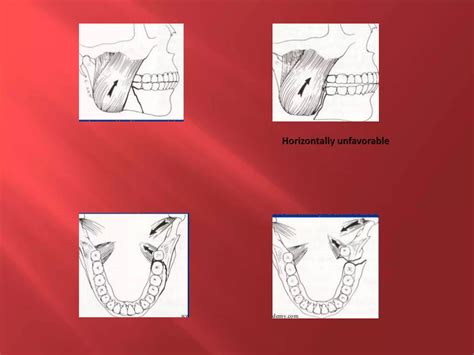 Mandibular Fracture Pptx