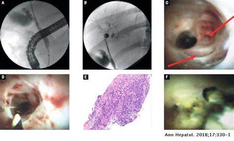 Impact Of Cholangioscopy Diagnosing Sclerosing Cholangitis Associated