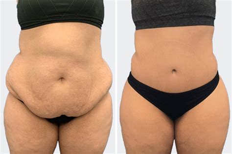 Best Tummy Tuck Cosmetic Surgery In India Nobel Essence