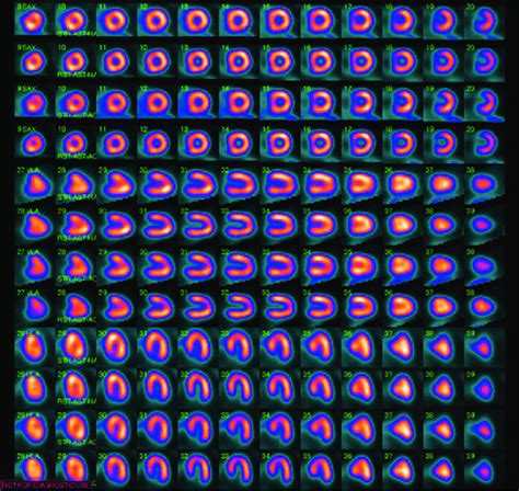 Stress And Rest Images Reveal A Nonreversible Perfusion Defect Of Mild