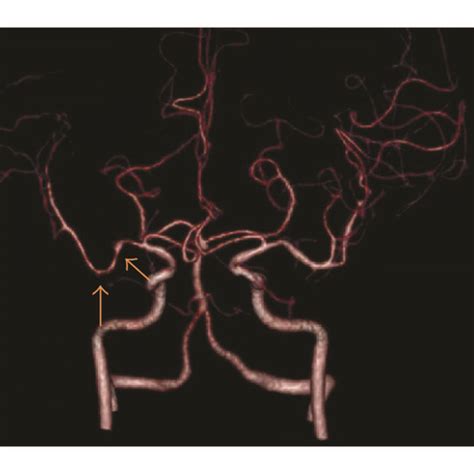 Ct Angiogram Of The Circle Of Willis Showing Multiple Areas Of Luminal