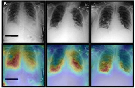 Transformer Based Multimodal Ai Model Improves Diagnosis Of Over 20 Conditions With Chest X Rays