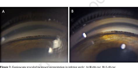 Bilateral Acute Iris Transillumination Syndrome After Sars Cov 2 Infection A Case Report