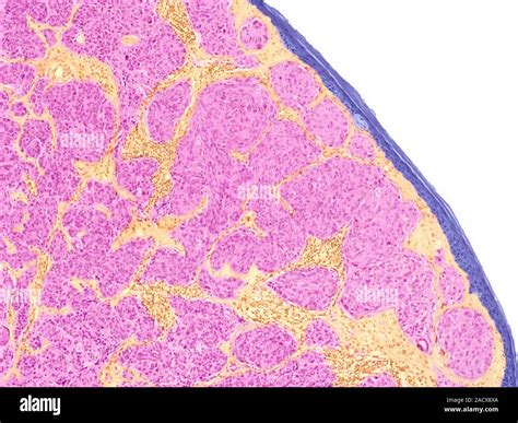 Spitz Nevus Light Micrograph Section Of Affected Skin From A Four Year