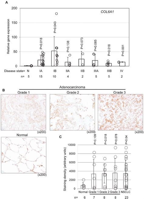 Expression Of Col6 In Normal And Neoplastic Lung Tissues A Col6a1 Download Scientific