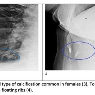 Central Type Calcification Pattern Common In Females Download Scientific Diagram