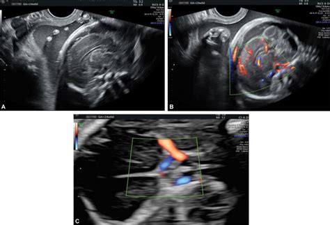 Sagittal View Showing Corpus Callosum Color Doppler Showing Download Scientific Diagram
